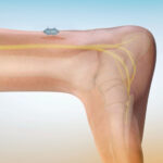 Neuromodulation UUI Therapy Device | BlueWind Revi